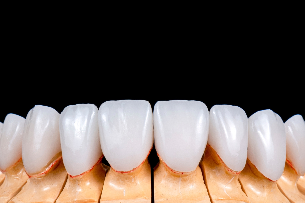 A Sneak Peek: Veneers Made Easy with 3D Imaging Technology